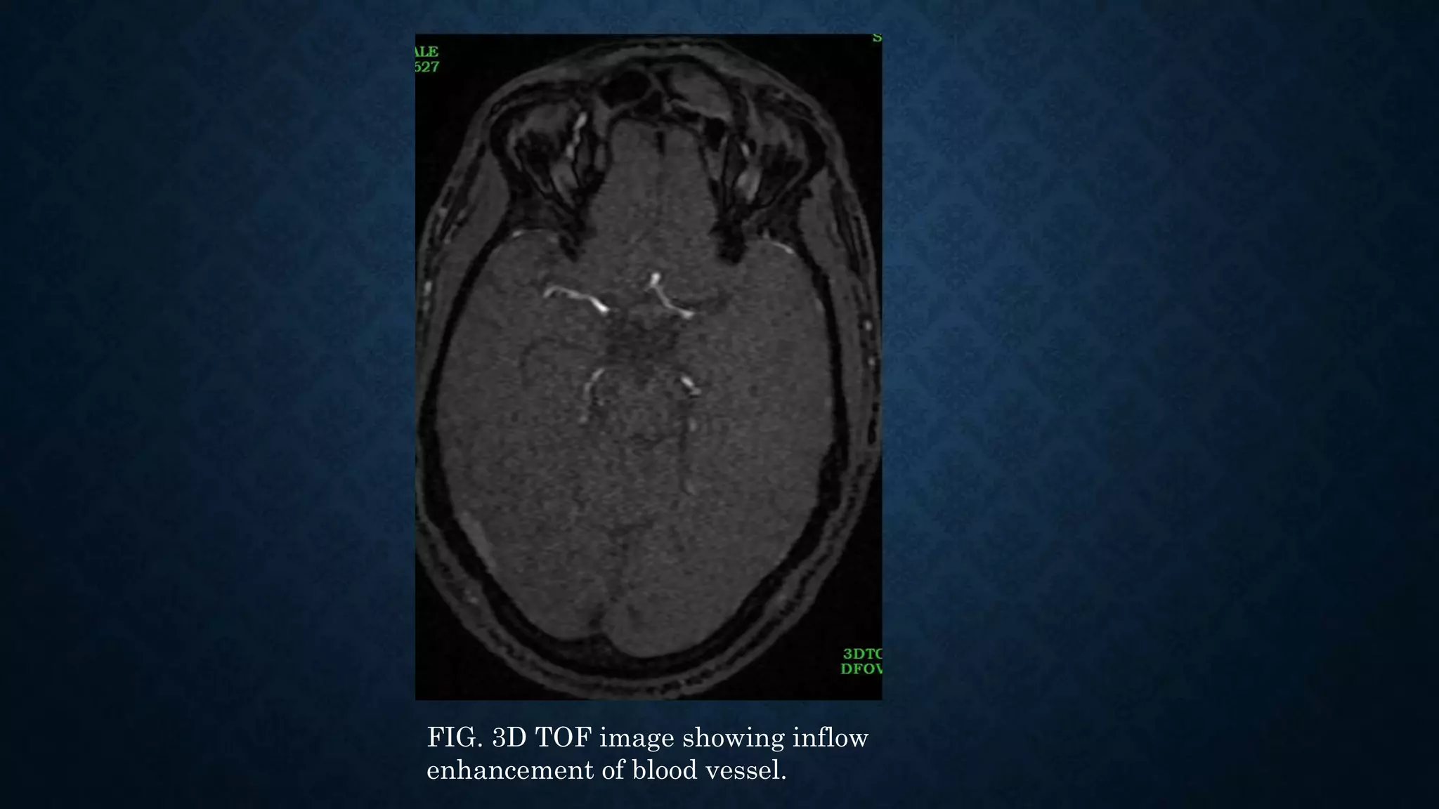 MR ANGIOGRAPHY PHYSICS | PPTX