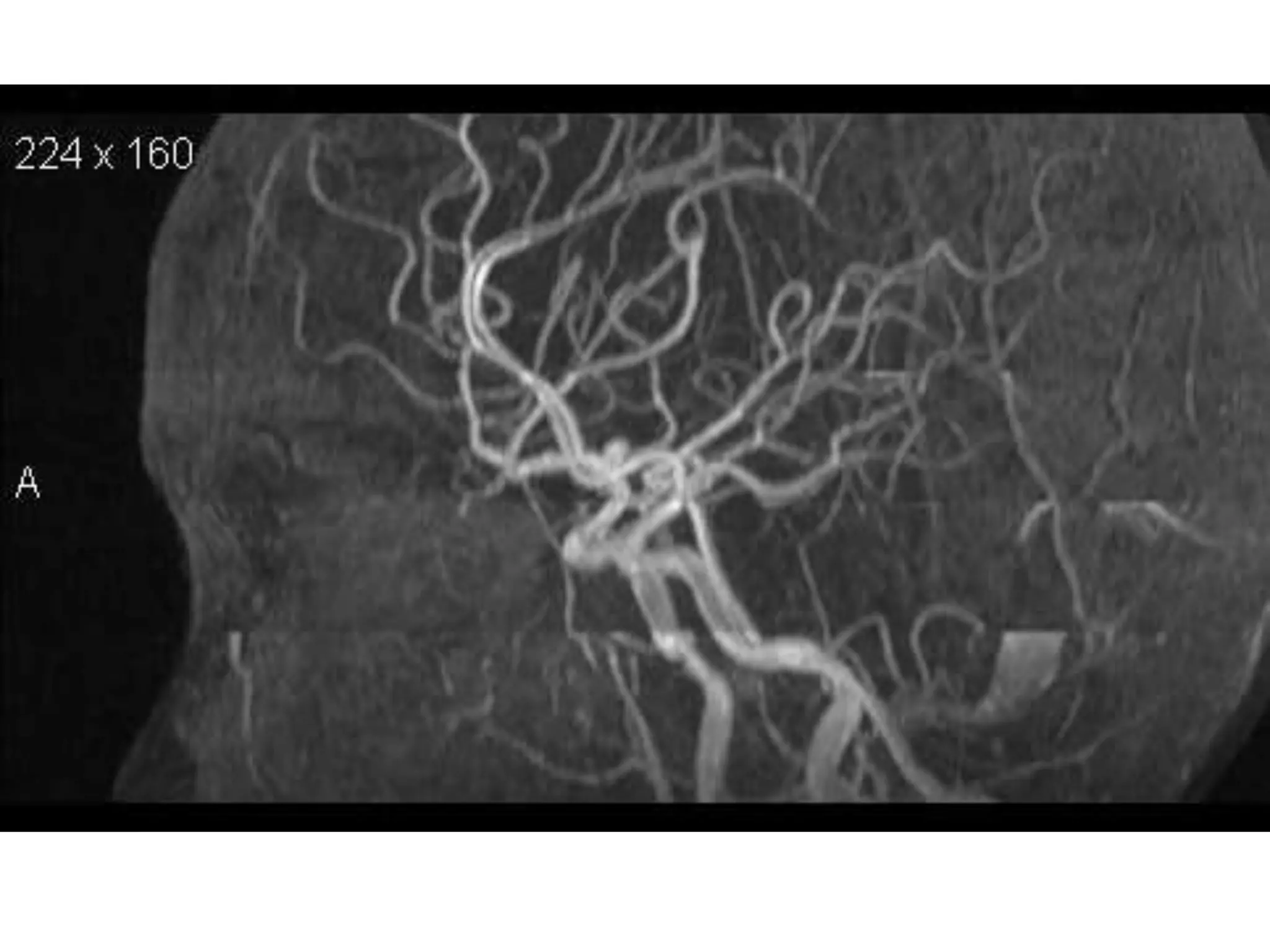 magnetic resonance angiography | PPTX | Brain and Nervous System ...