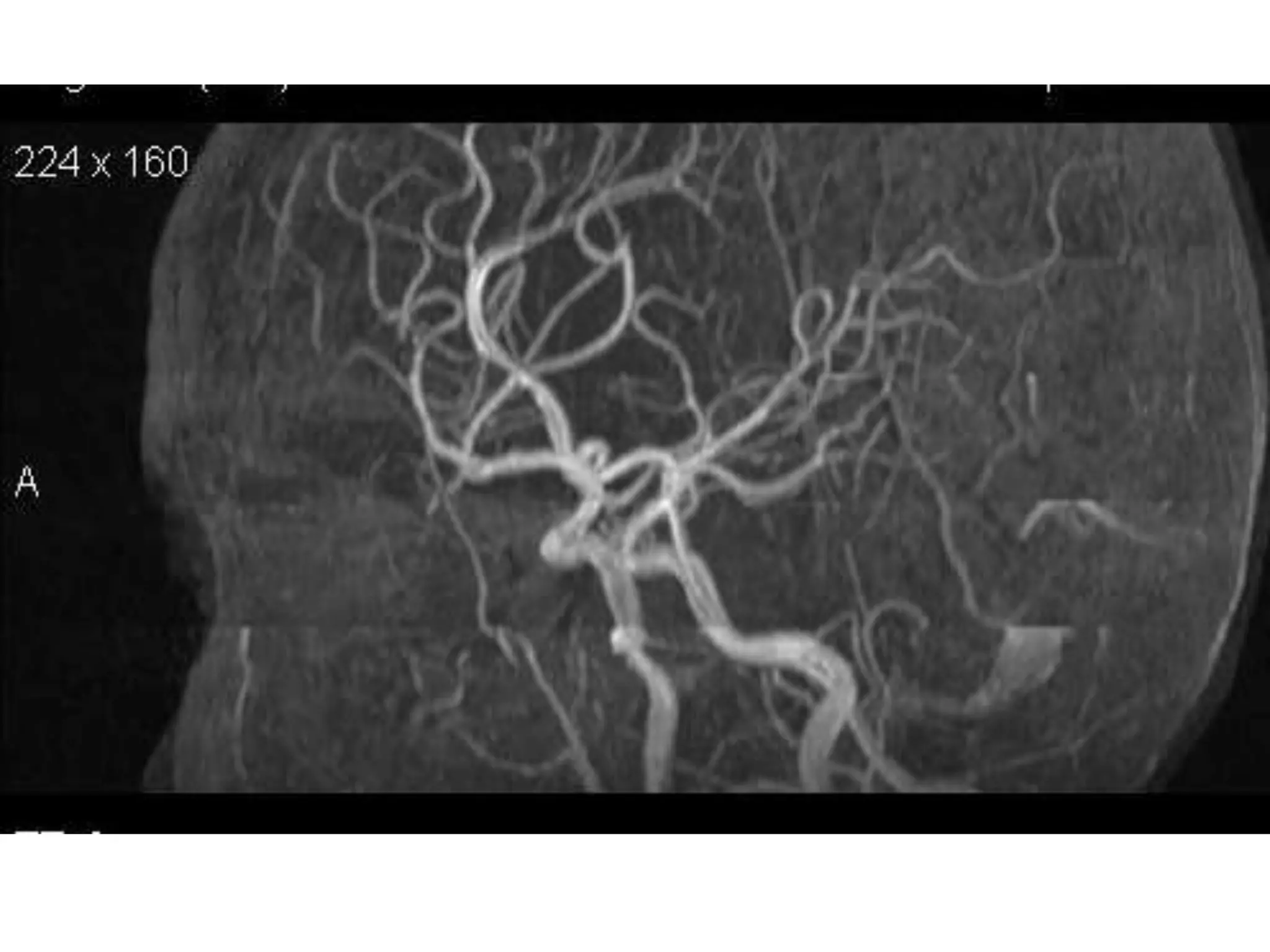 magnetic resonance angiography | PPTX