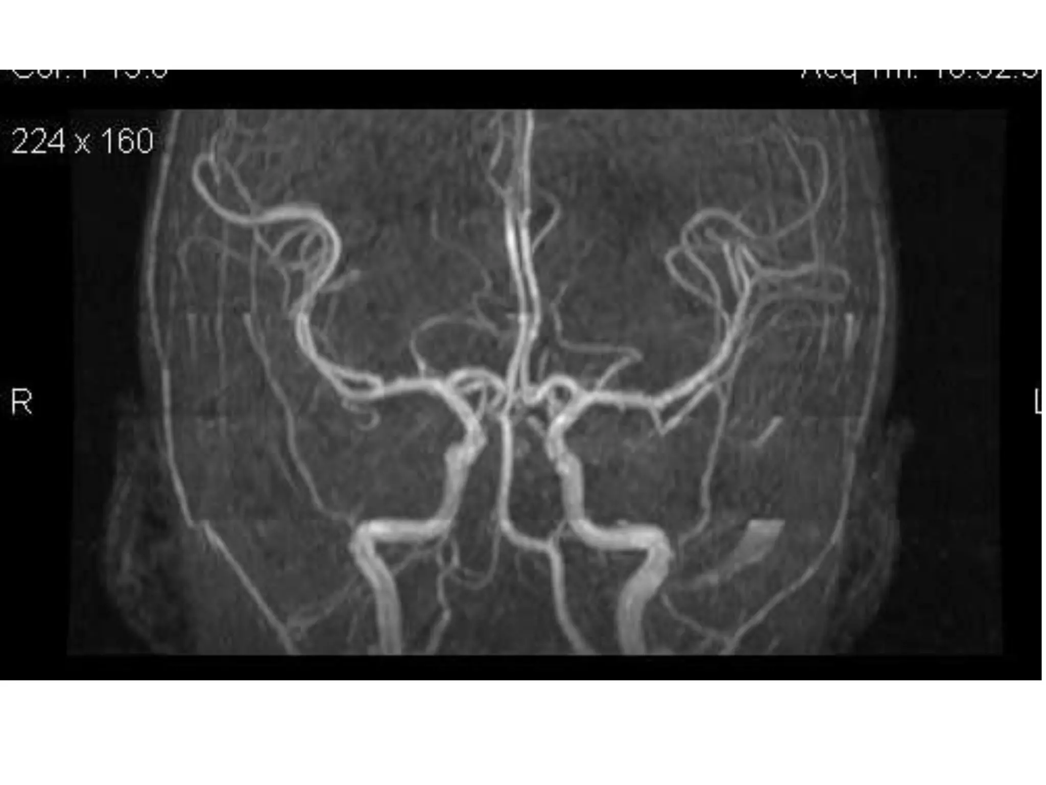 magnetic resonance angiography | PPTX | Brain and Nervous System ...