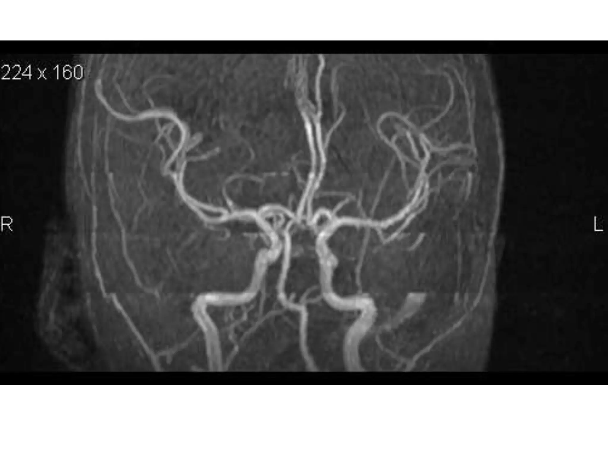 magnetic resonance angiography | PPTX | Brain and Nervous System ...