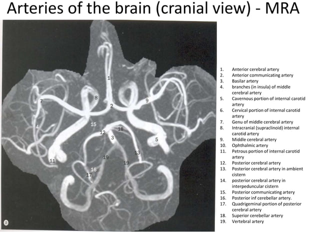 magnetic resonance angiography | PPTX | Brain and Nervous System ...
