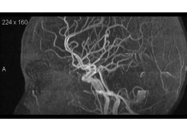 magnetic resonance angiography | PPTX | Brain and Nervous System ...