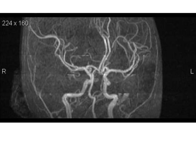 magnetic resonance angiography | PPT