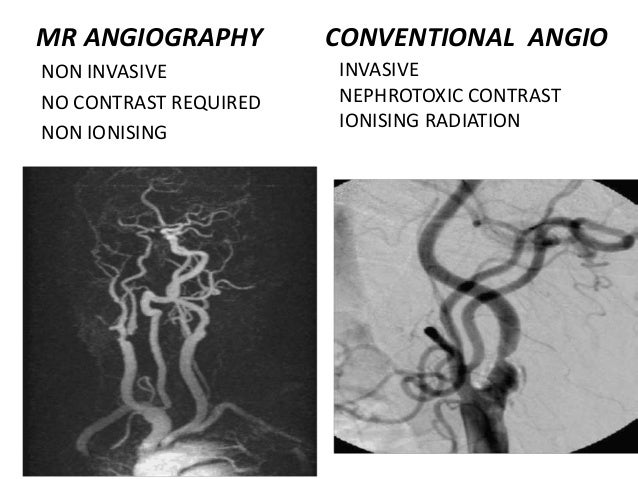 magnetic resonance angiography