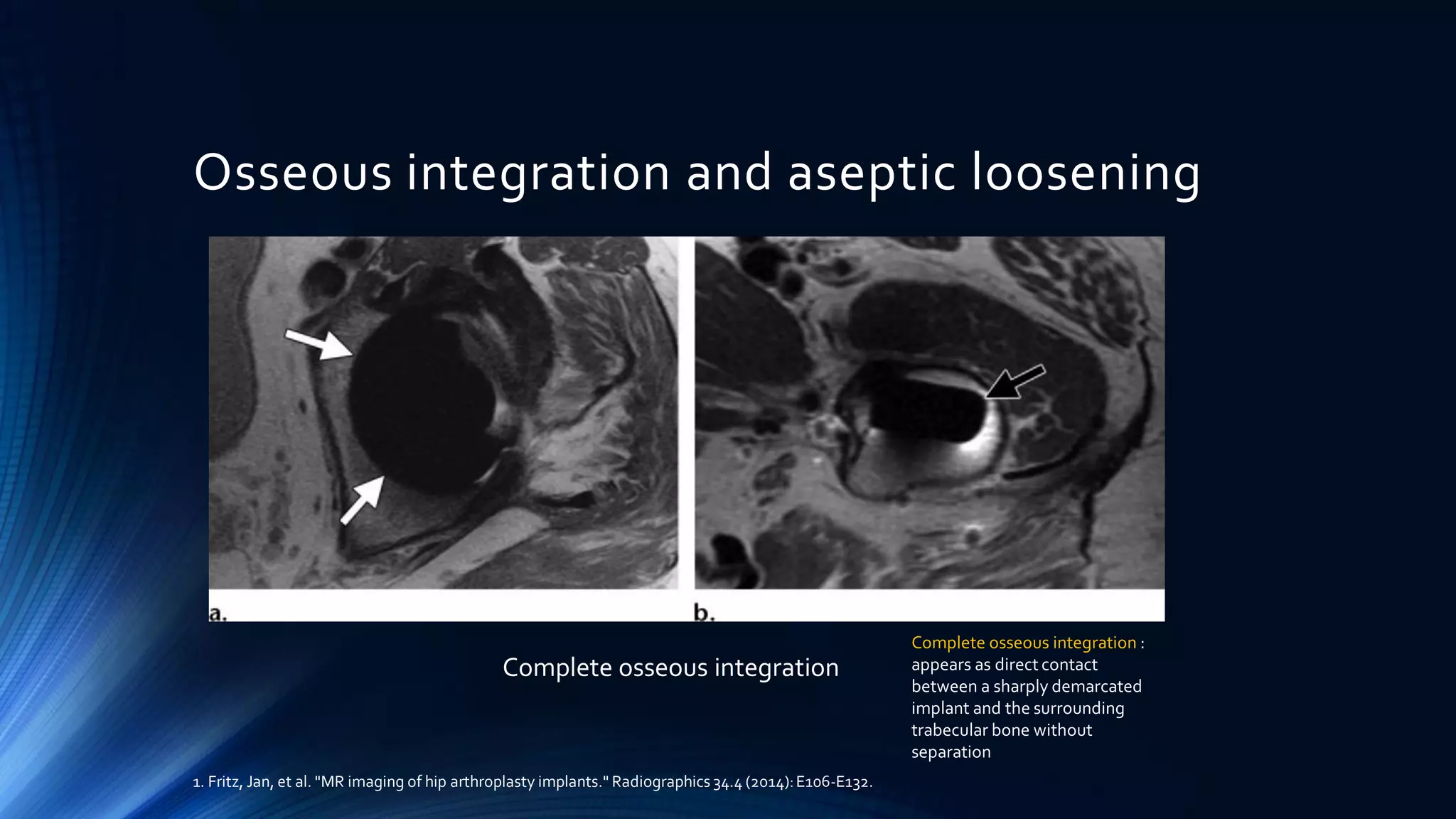 MRI post hip arthroplasty | PDF
