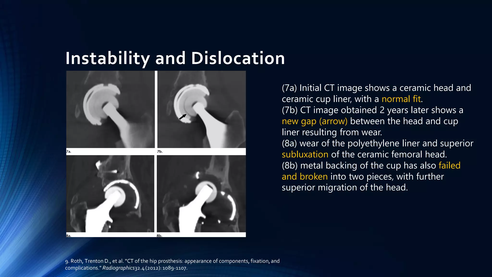 MRI post hip arthroplasty | PDF