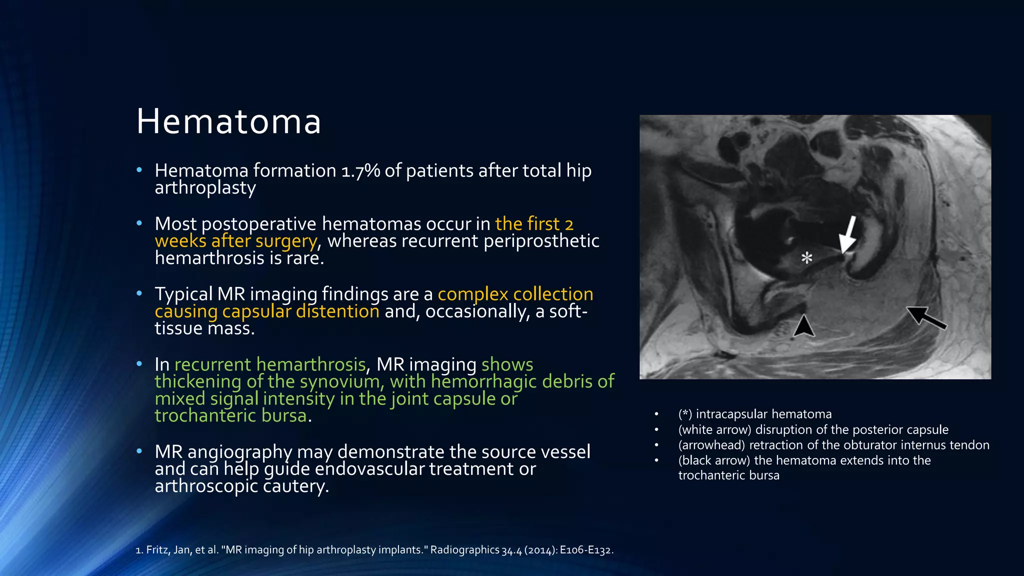 MRI post hip arthroplasty | PDF