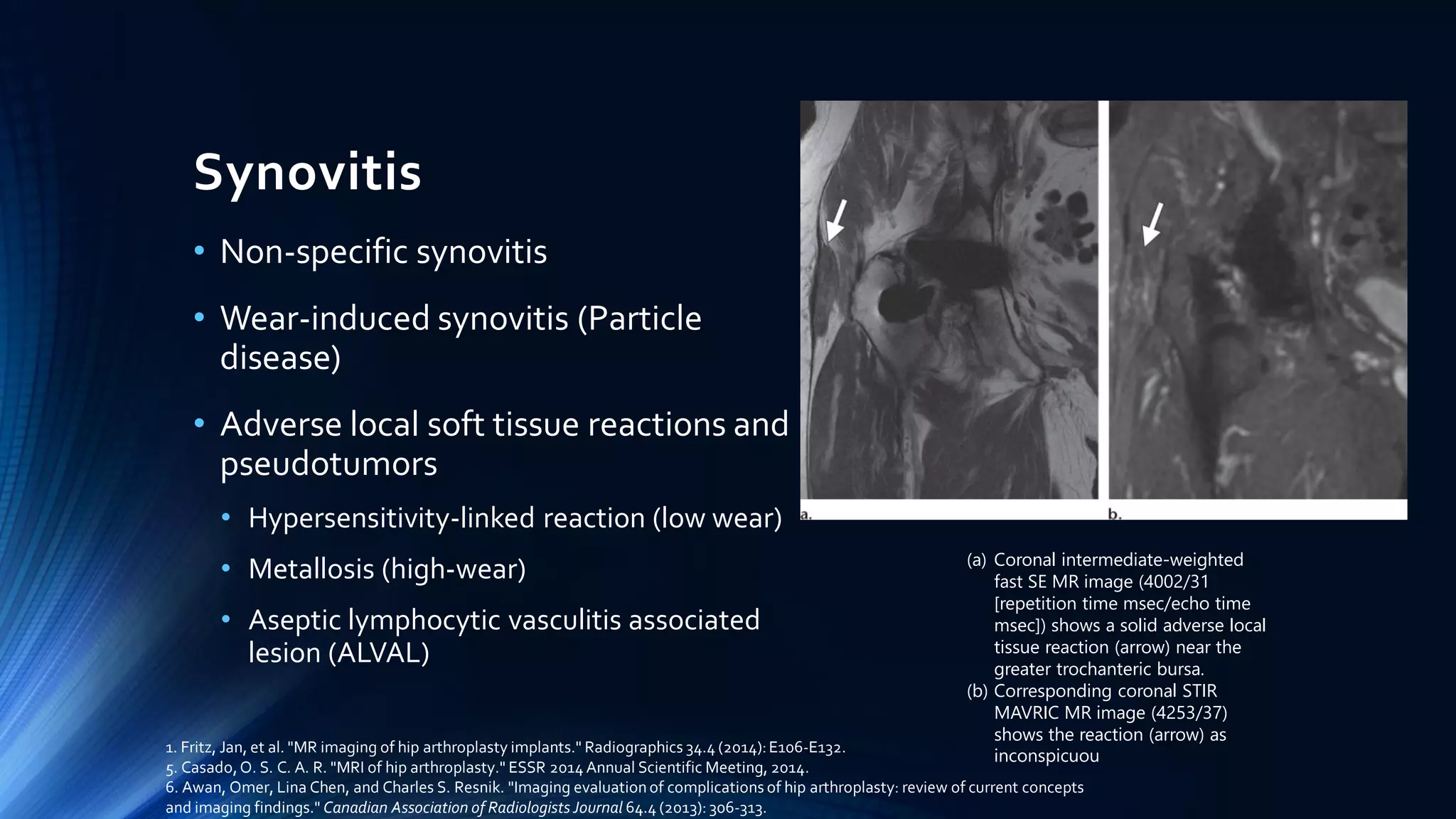 MRI post hip arthroplasty | PDF