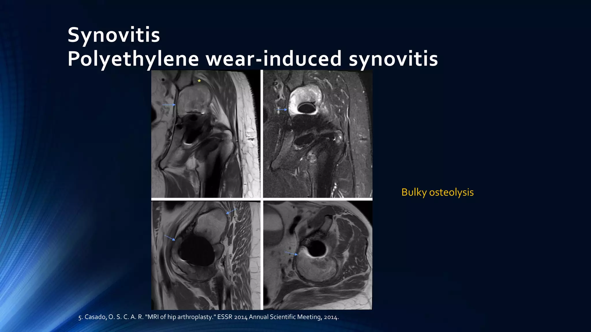 MRI post hip arthroplasty | PDF