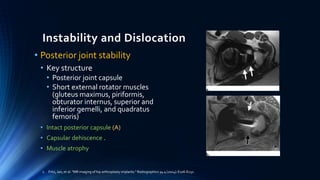 MRI post hip arthroplasty | PDF