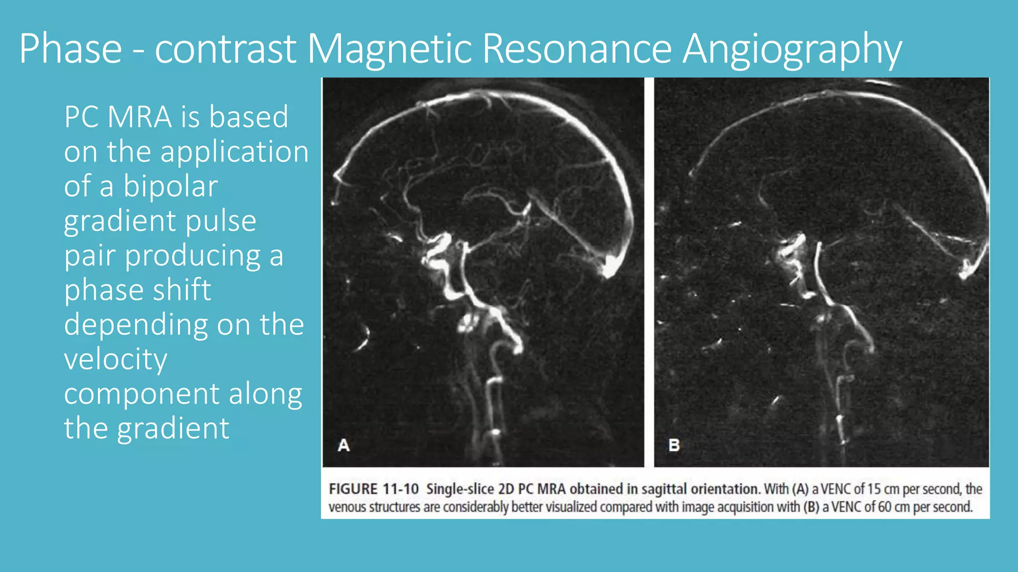 Magnetic Resonance Angiography and Venography | PPTX