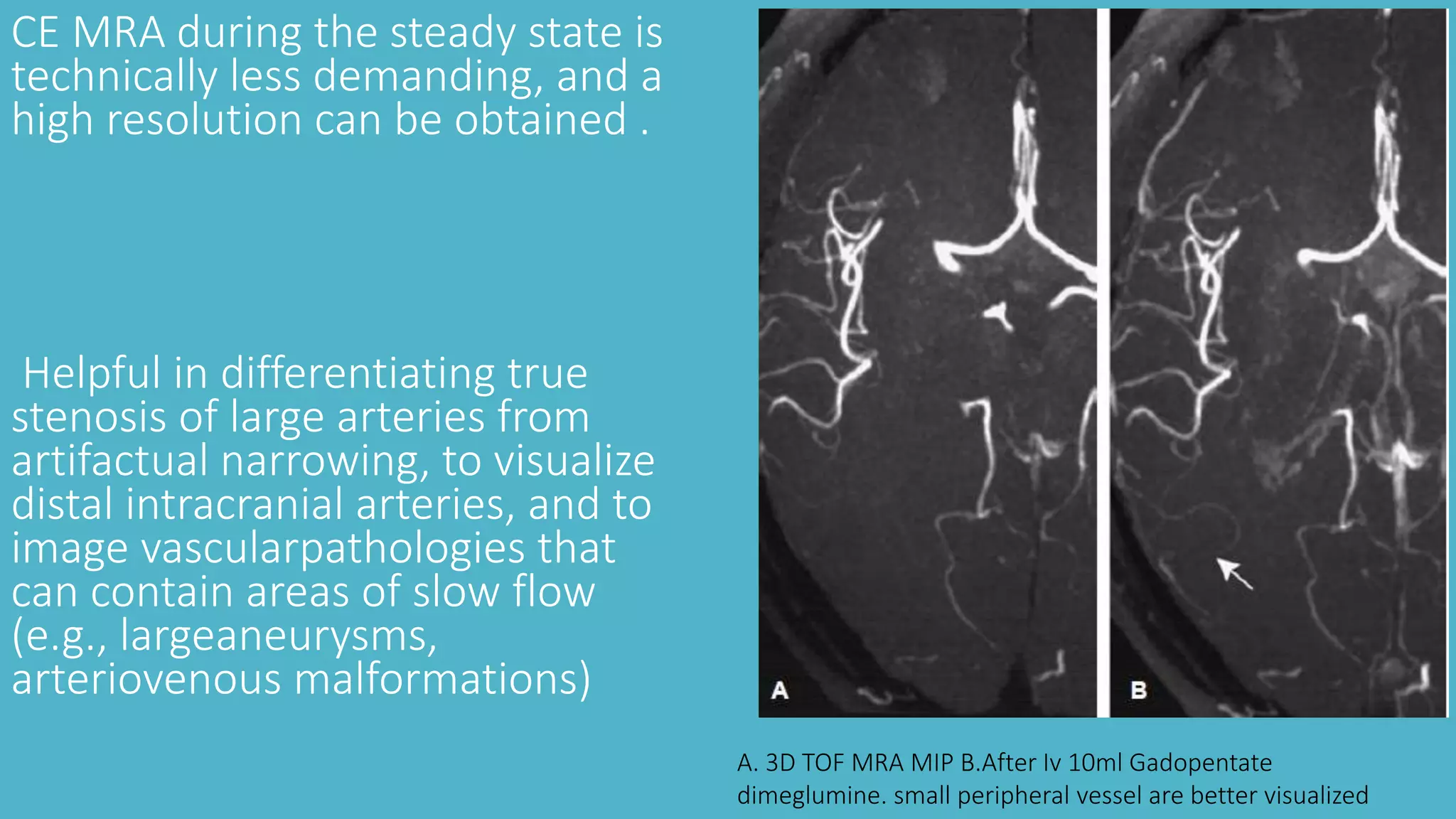 Magnetic Resonance Angiography and Venography | PPTX