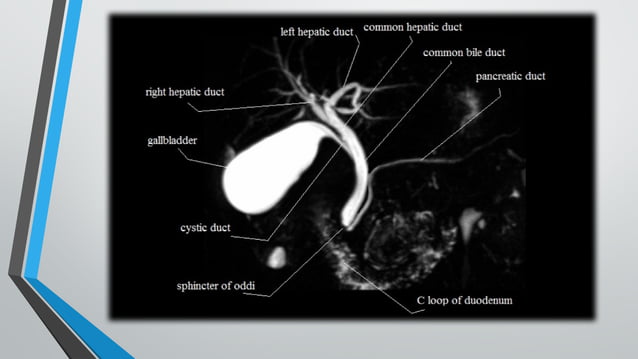 MRCP (Magnetic resonance cholangiopancreatography) | PPT