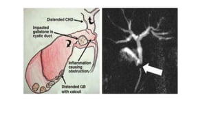 MRCP imaging of radiology mri technique see | PPTX