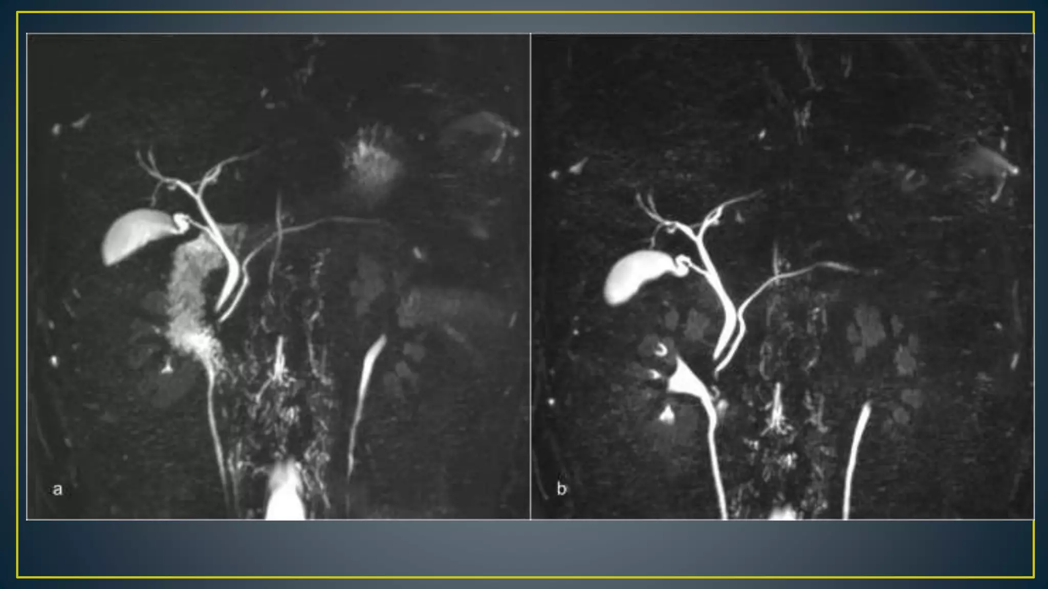 MRCP Magnetic Resonance cholangiopancreatography | PPTX | Lung and Respiratory Health | Diseases ...
