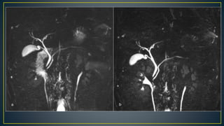 MRCP Magnetic Resonance cholangiopancreatography | PPTX
