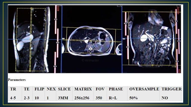 MRCP Magnetic Resonance cholangiopancreatography | PPTX | Lung and Respiratory Health | Diseases ...