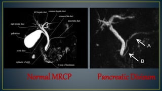 MRCP Magnetic Resonance cholangiopancreatography | PPTX