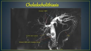 Choledocholithiasis Mrcp