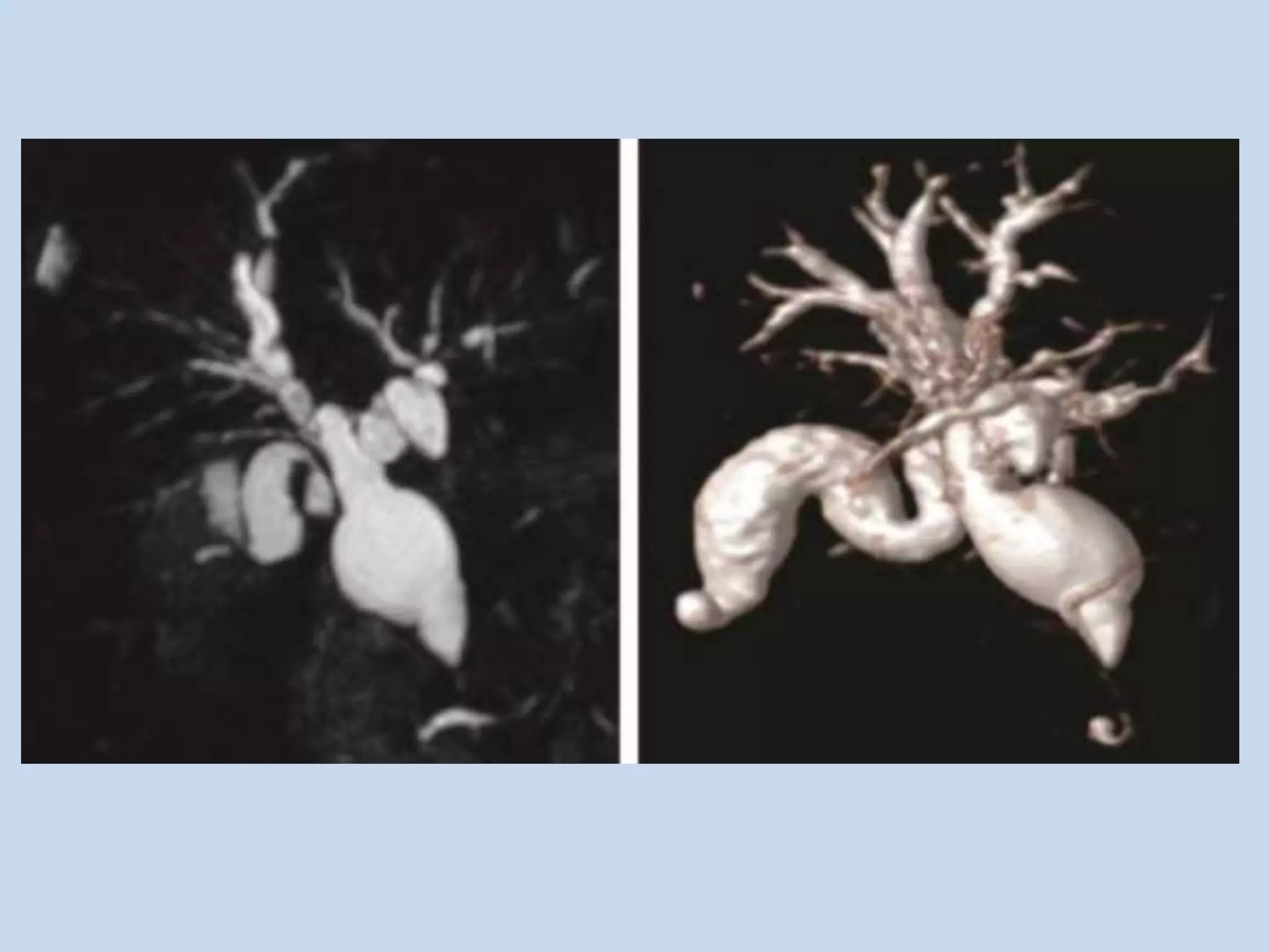 Mrcp radiology | PPTX