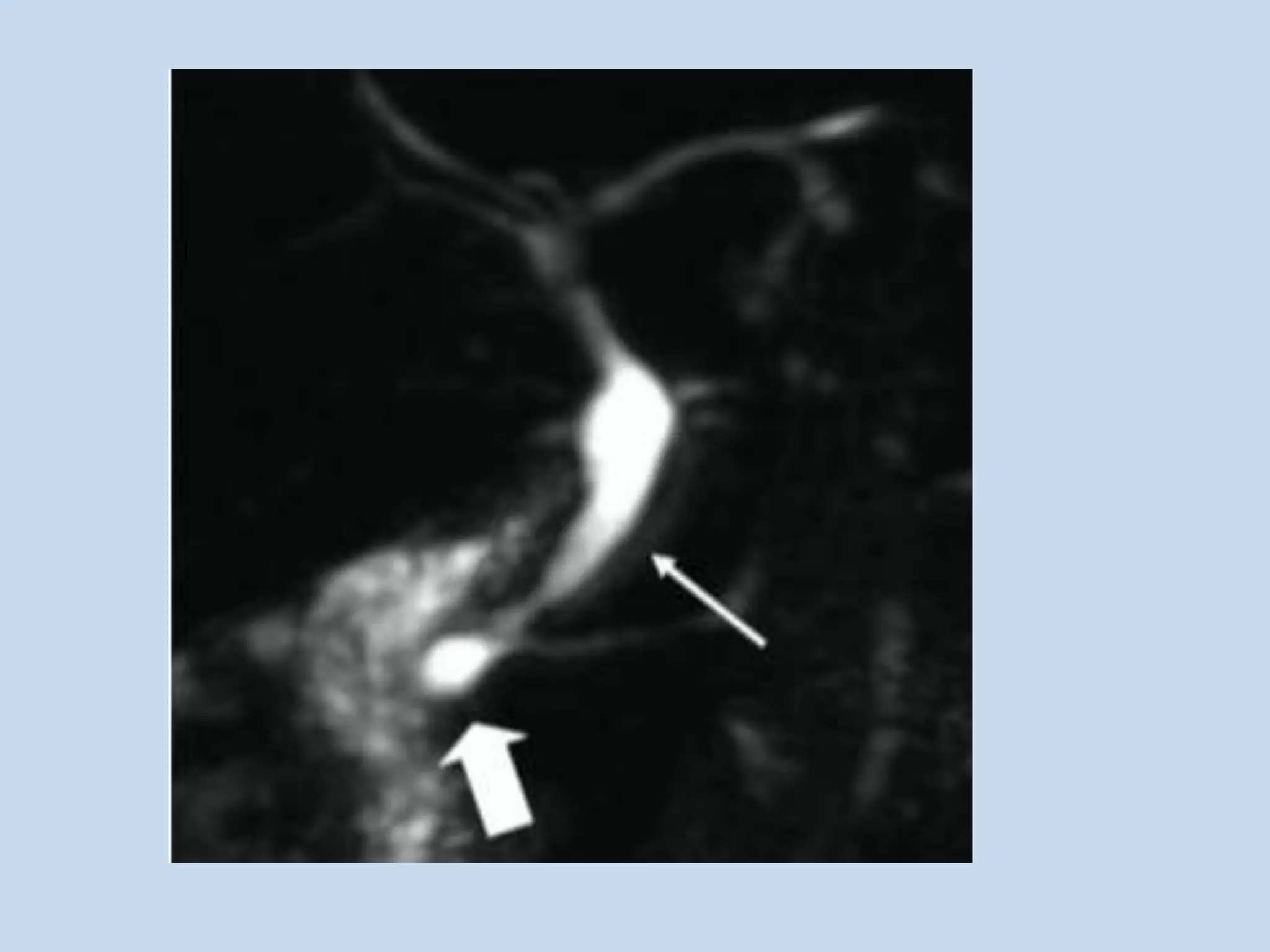 Mrcp radiology | PPTX