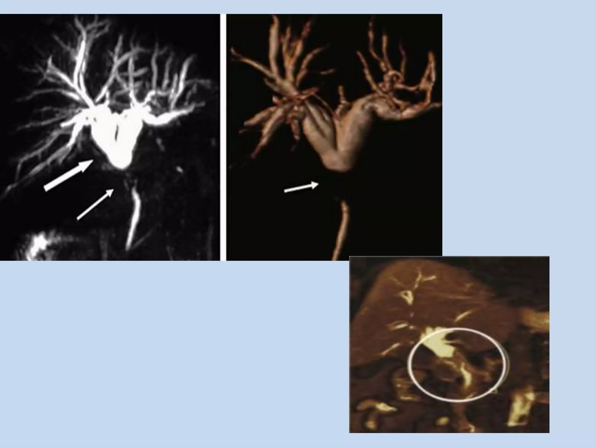 Mrcp radiology | PPTX