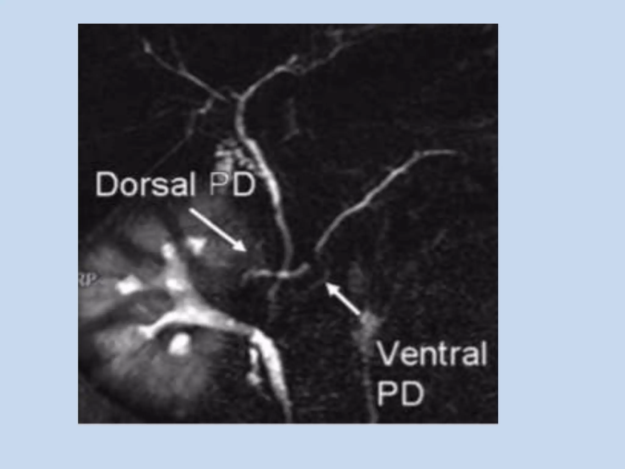Mrcp radiology | PPTX