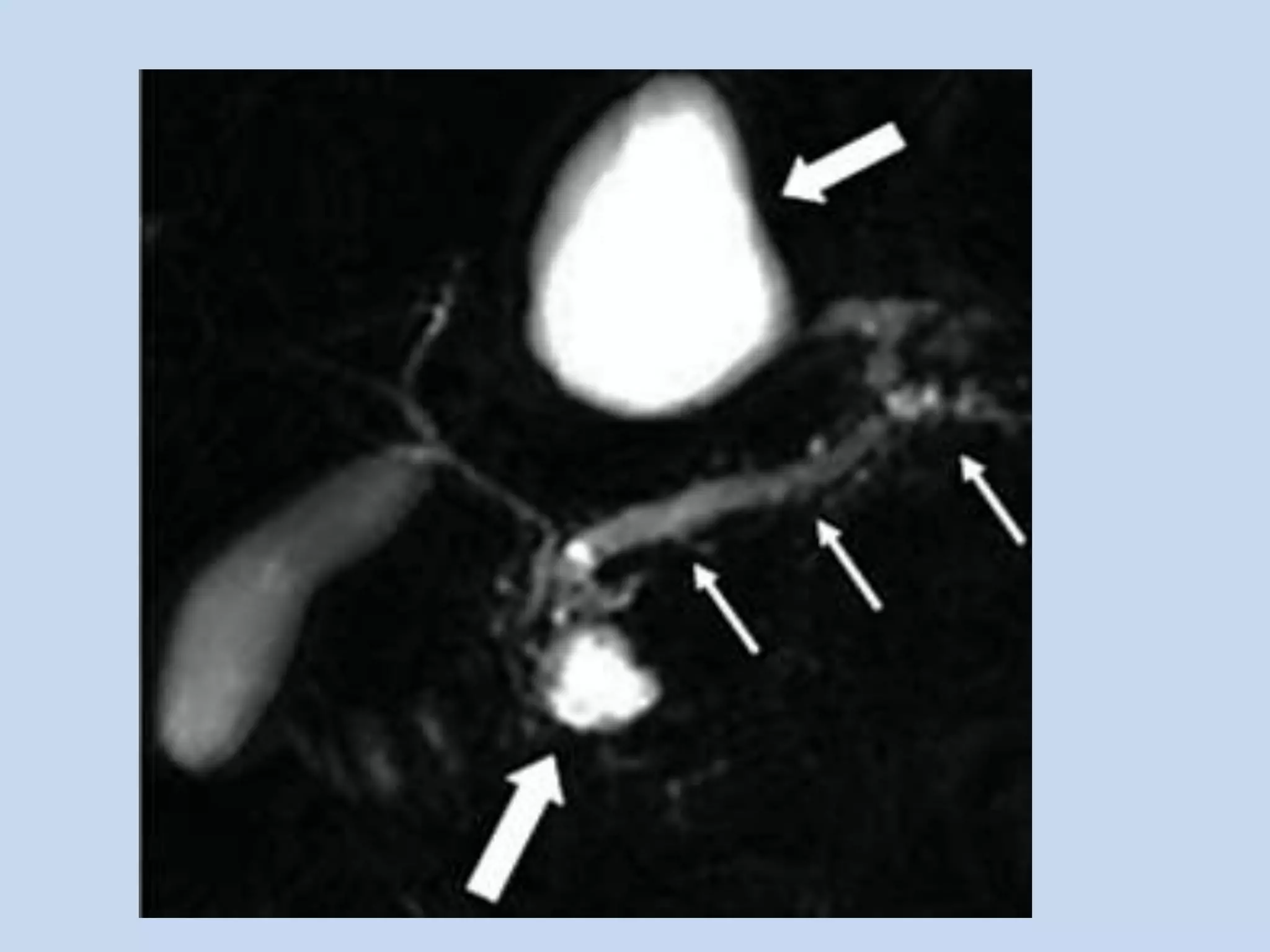 Mrcp radiology | PPTX