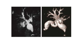 Magnetic Resonance Cholangiopancreatography- MRCP | PPTX