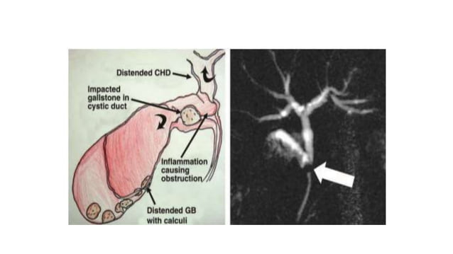 Magnetic Resonance Cholangiopancreatography- MRCP | PPTX | Digestive Disorders | Diseases and ...