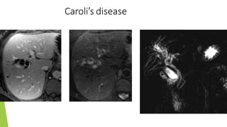 Magnetic Resonance Cholangiopancreatography- MRCP | PPTX