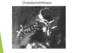 Magnetic Resonance Cholangiopancreatography- MRCP | PPTX