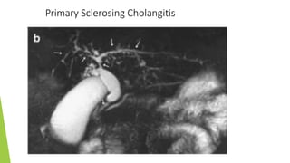 Magnetic Resonance Cholangiopancreatography- MRCP | PPTX