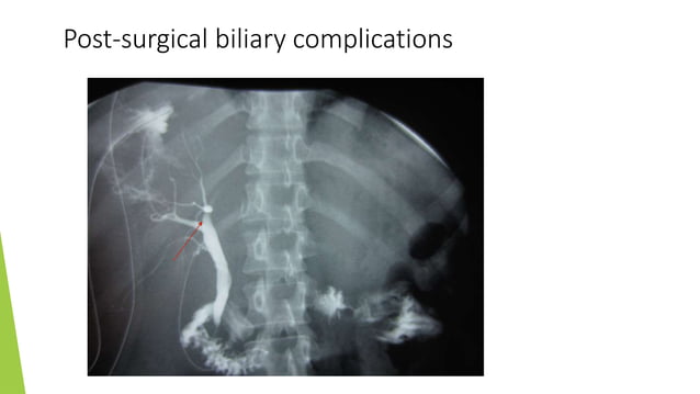 Magnetic Resonance Cholangiopancreatography- MRCP | PPTX | Digestive Disorders | Diseases and ...