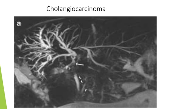 Magnetic Resonance Cholangiopancreatography- MRCP | PPTX | Digestive Disorders | Diseases and ...