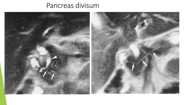 Magnetic Resonance Cholangiopancreatography- MRCP | PPTX | Digestive Disorders | Diseases and ...