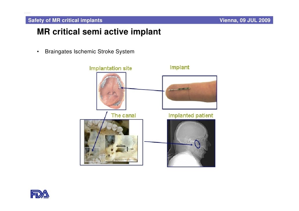 Safety of MRI Critical Medical Devices