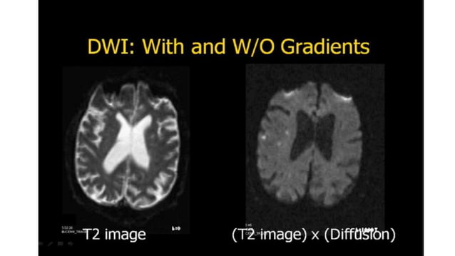 MR DIFFUSION PERFUSION & ARTIFACTS.pptx | Free Download