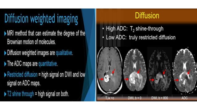 MR DIFFUSION PERFUSION & ARTIFACTS.pptx | Free Download