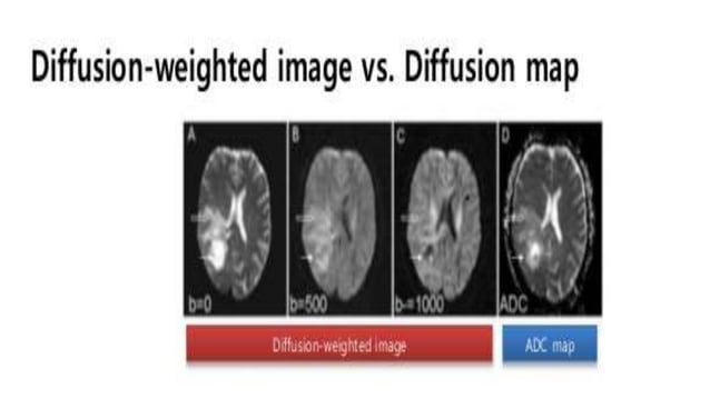MR DIFFUSION PERFUSION & ARTIFACTS.pptx | Free Download