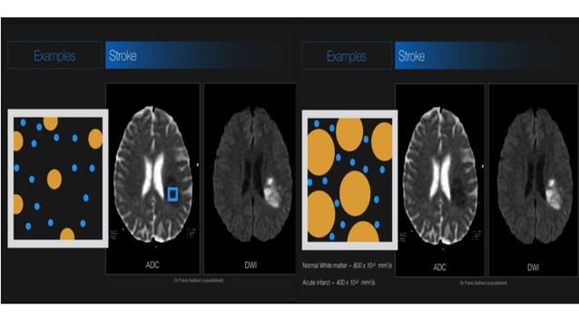 MR DIFFUSION PERFUSION & ARTIFACTS.pptx | Free Download