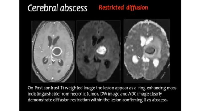 MR DIFFUSION PERFUSION & ARTIFACTS.pptx | Free Download