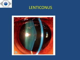 ANATOMY_OF_LENS presentation dhir hospital.pptx