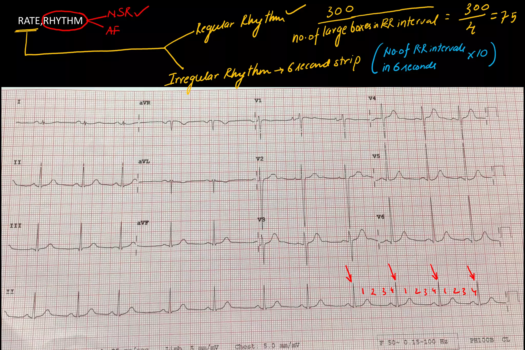 Mitral Regurgitation - ECG , Chest X- Ray | PDF