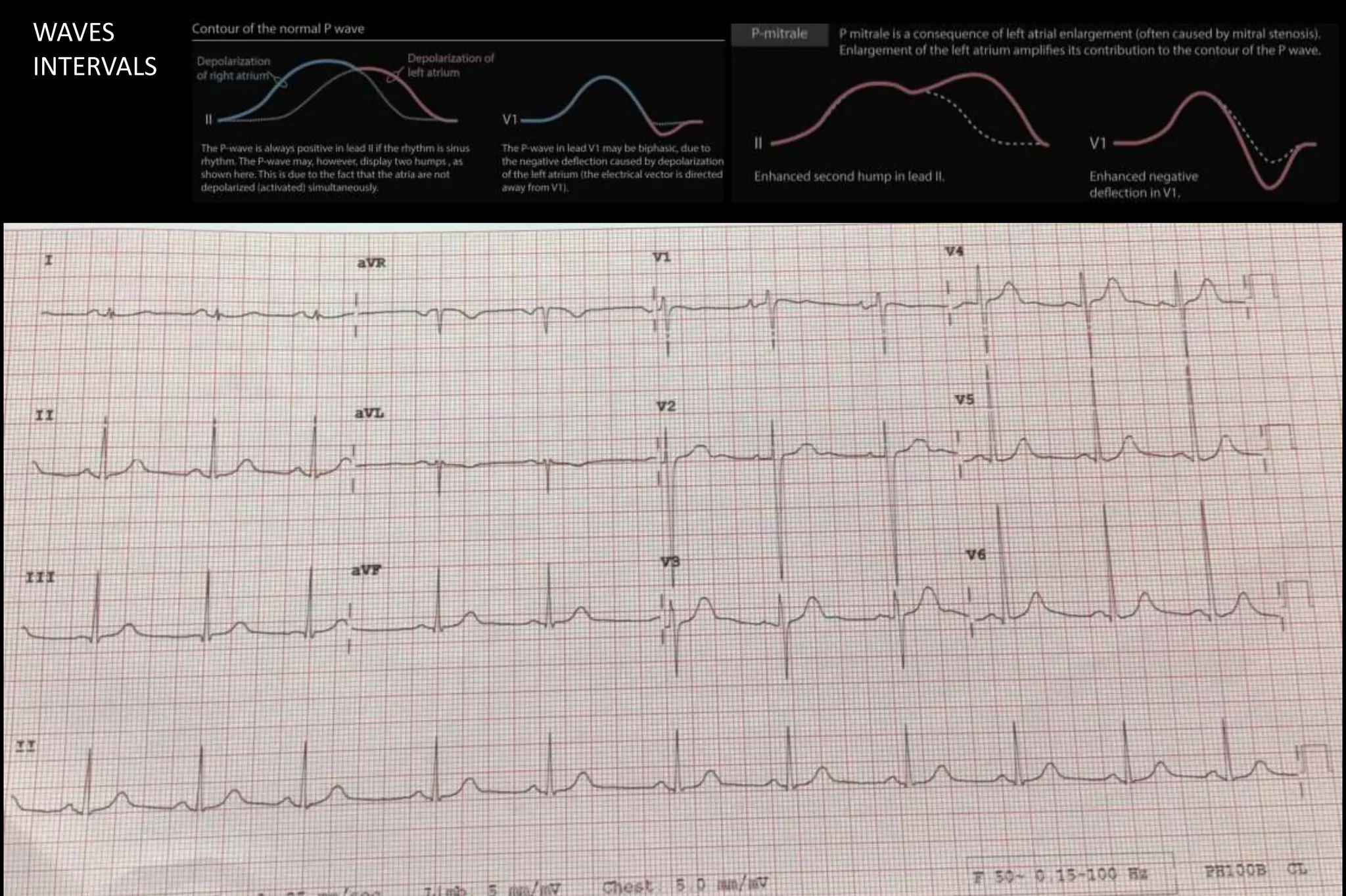 ECG CHEST X-RAY IN MITRAL REGURGITATION | PPTX