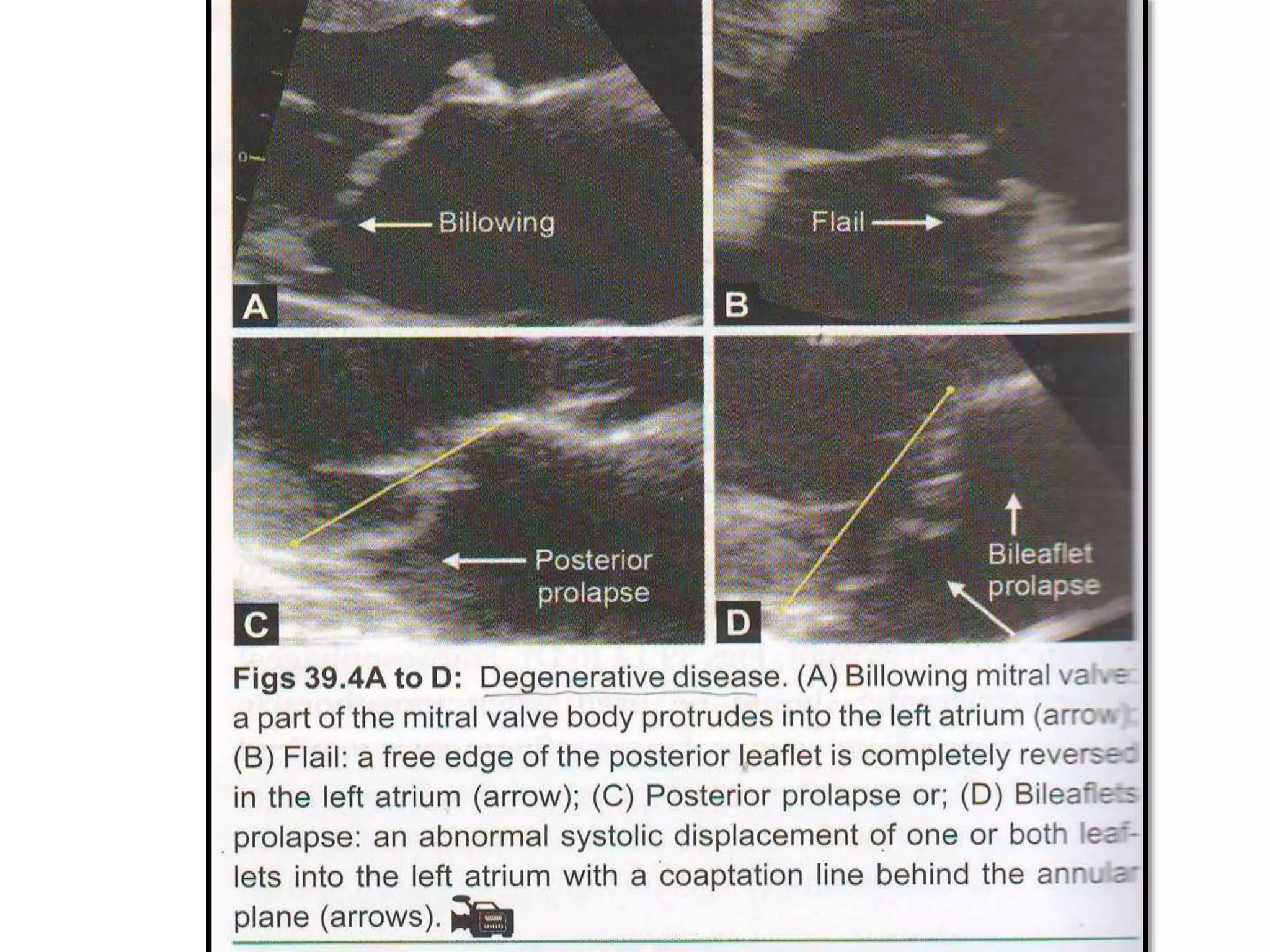 ECHOCARDIOGRAPHIC EVALUATION OF MITRAL VALVE DISEASE -MITRAL ...