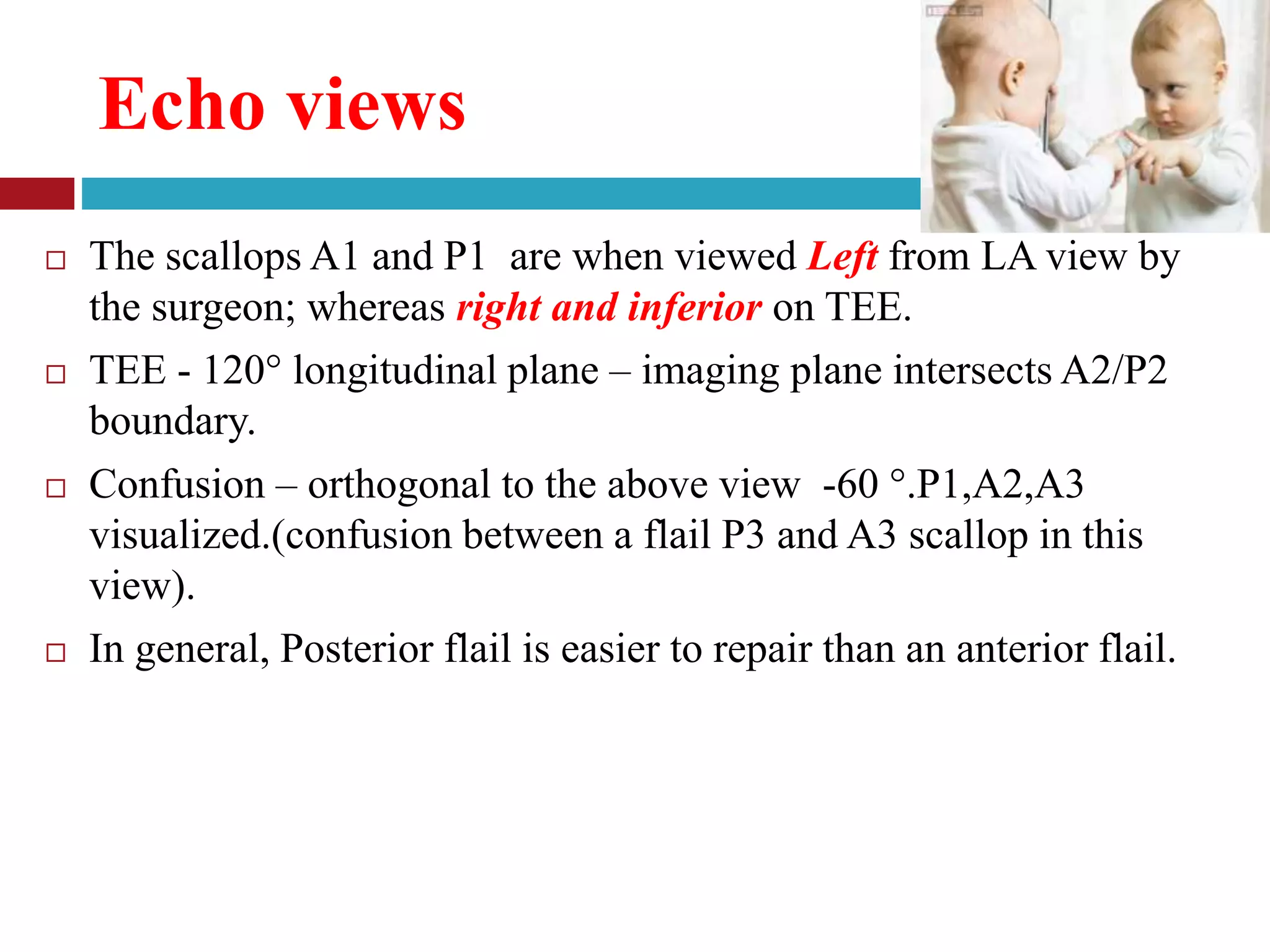 ECHOCARDIOGRAPHIC EVALUATION OF MITRAL VALVE DISEASE -MITRAL ...