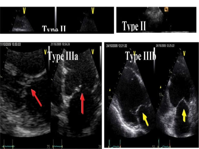 ECHOCARDIOGRAPHIC EVALUATION OF MITRAL VALVE DISEASE -MITRAL REGURGITATION | PPT