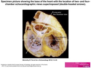 ECHOCARDIOGRAPHIC EVALUATION OF MITRAL VALVE DISEASE -MITRAL ...